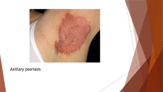 PSORIASIS dermatology slides for medical students | PPTX