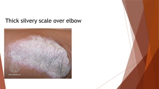 PSORIASIS dermatology slides for medical students | PPTX