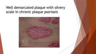 PSORIASIS dermatology slides for medical students | PPTX