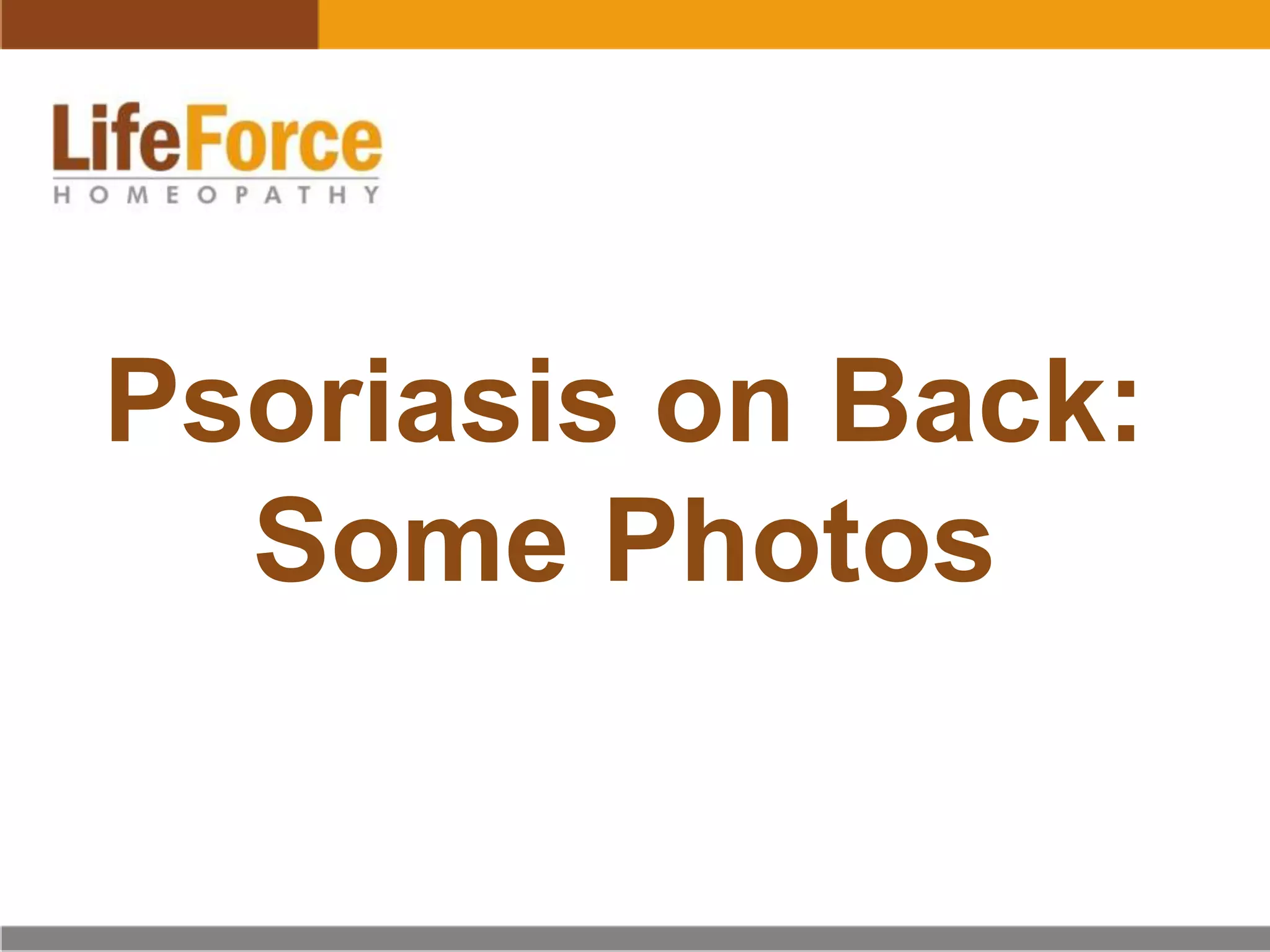 Psoriasis on Back Photos: Before After Treatment Pictures of Patients ...
