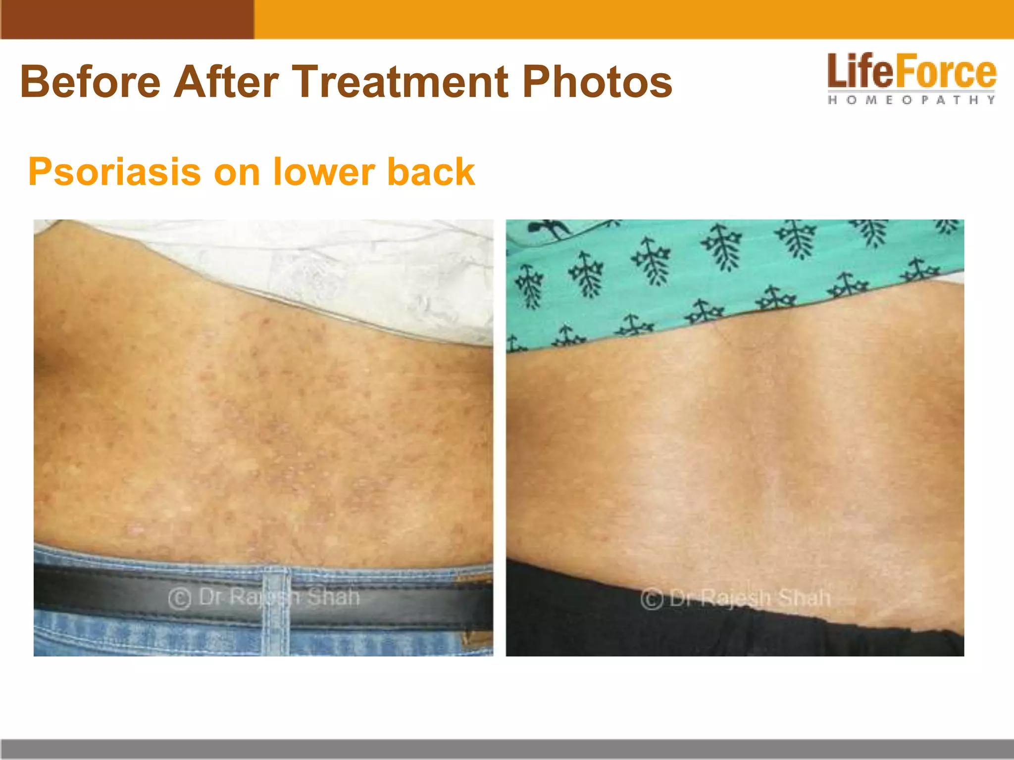 Psoriasis on Back Photos: Before After Treatment Pictures of Patients ...