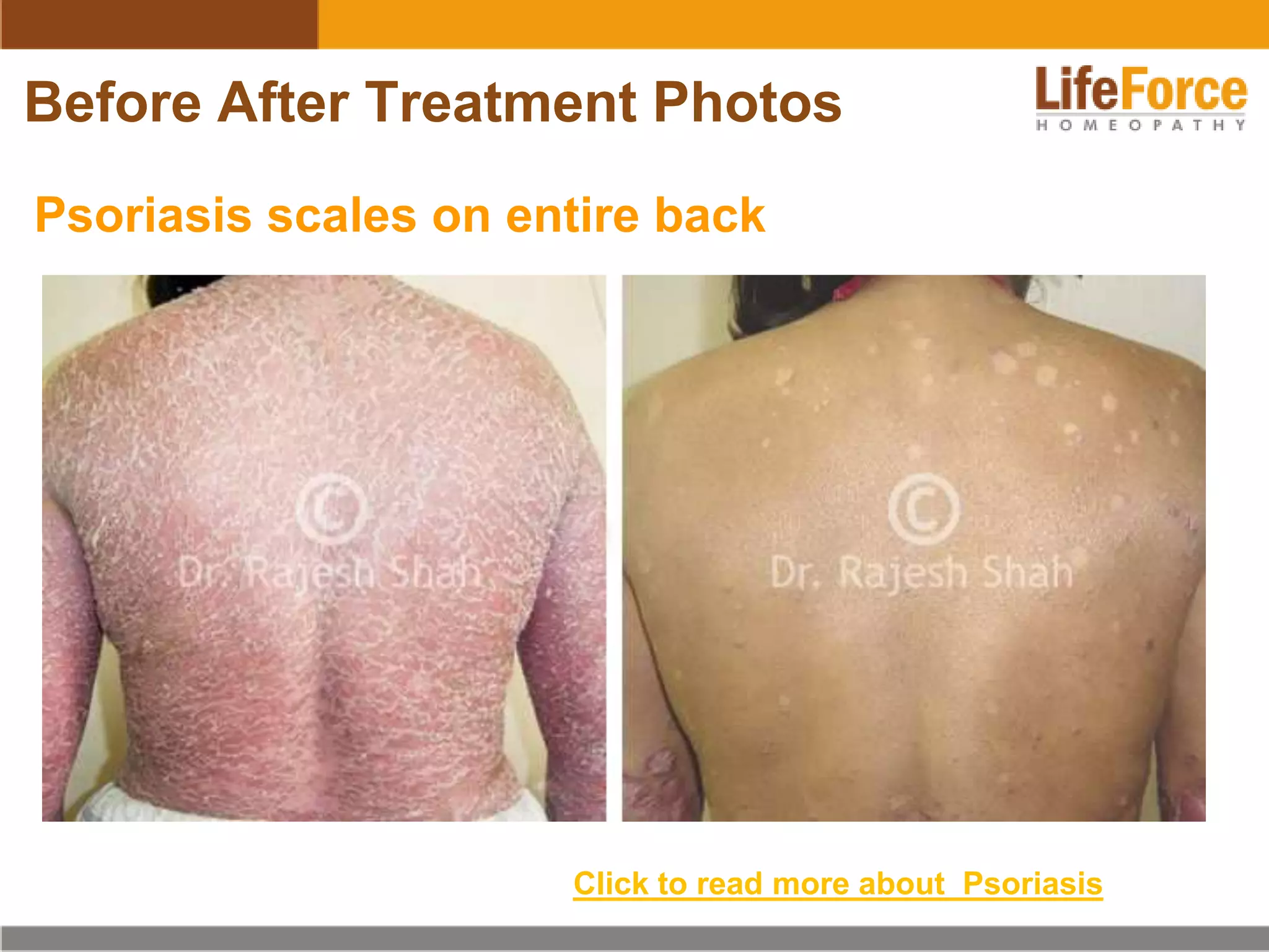 Psoriasis on Back Photos: Before After Treatment Pictures of Patients ...