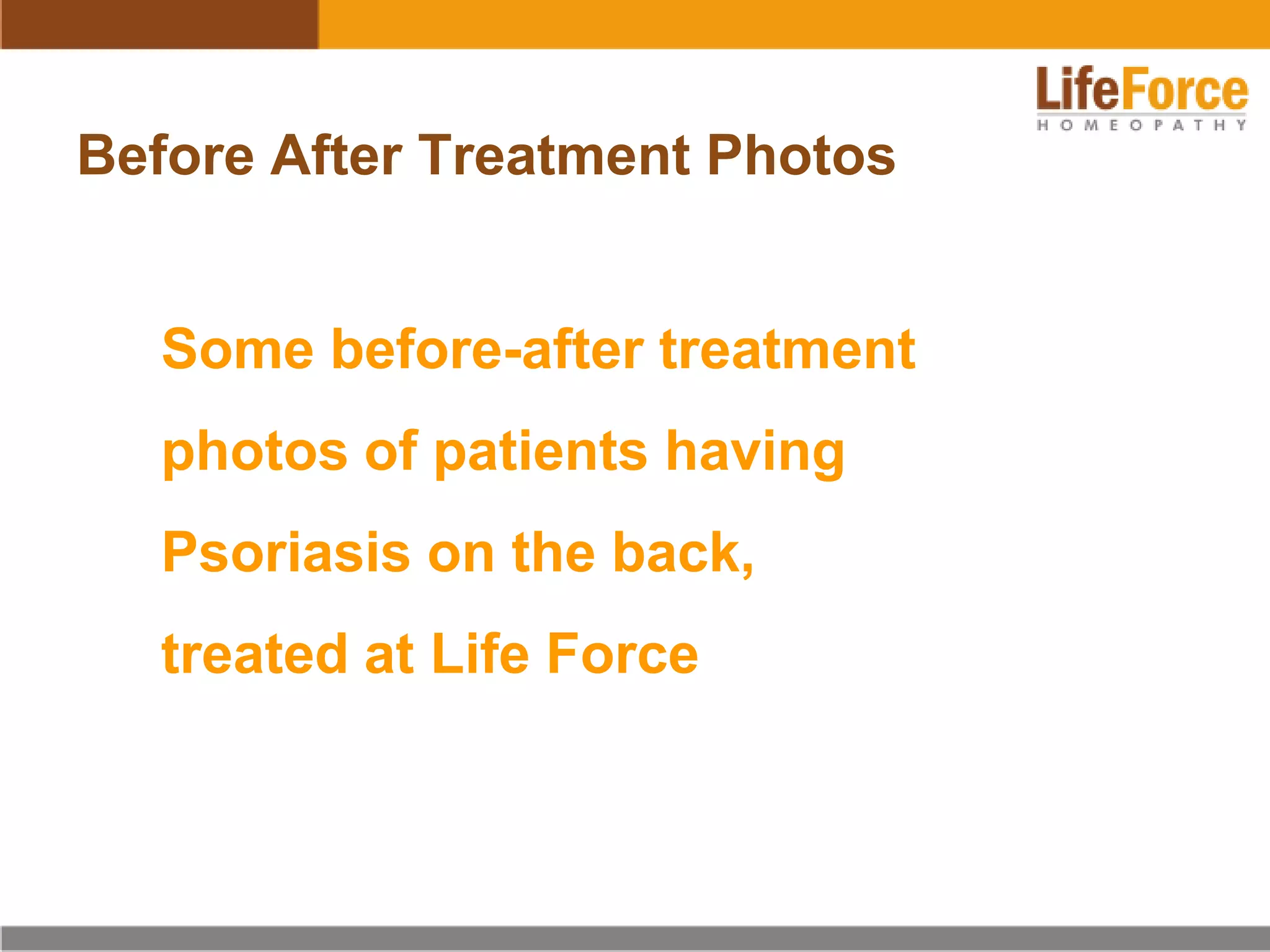 Psoriasis on Back Photos: Before After Treatment Pictures of Patients ...