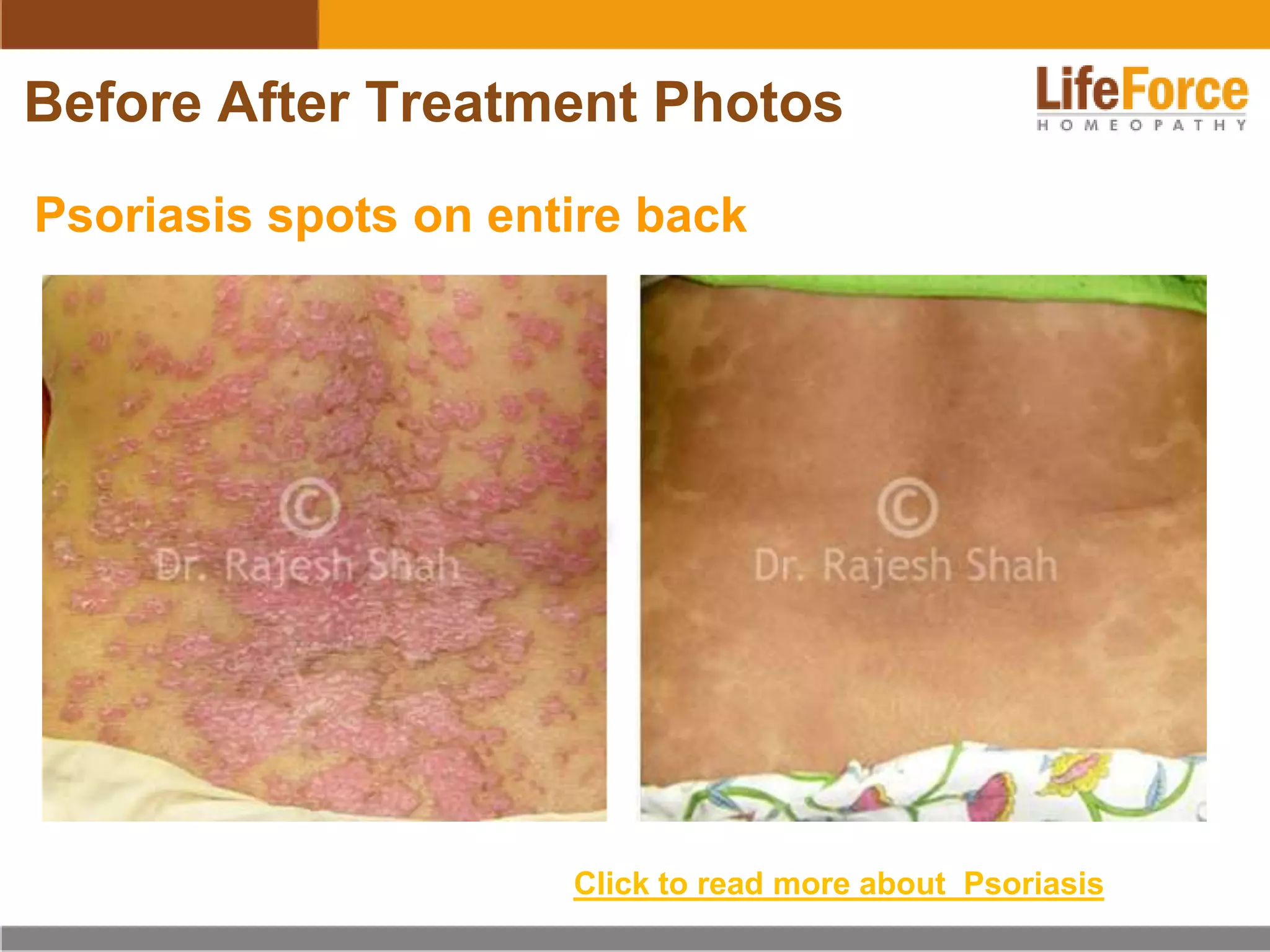 Psoriasis on Back Photos: Before After Treatment Pictures of Patients ...