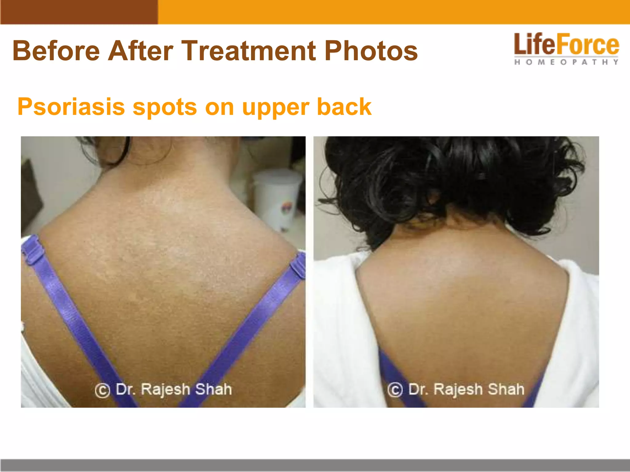 Psoriasis on Back Photos: Before After Treatment Pictures of Patients ...