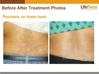 Psoriasis on Back Photos: Before After Treatment Pictures of Patients ...