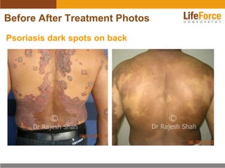 Psoriasis on Back Photos: Before After Treatment Pictures of Patients ...