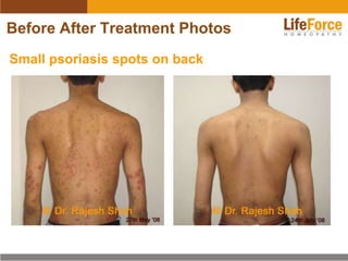 Psoriasis on Back Photos: Before After Treatment Pictures of Patients ...