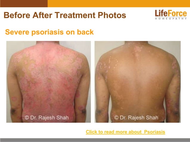 Psoriasis on Back Photos: Before After Treatment Pictures of Patients ...
