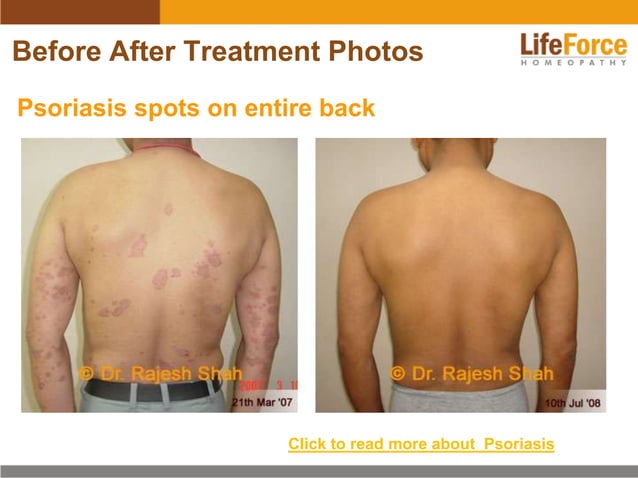 Psoriasis on Back Photos: Before After Treatment Pictures of Patients ...