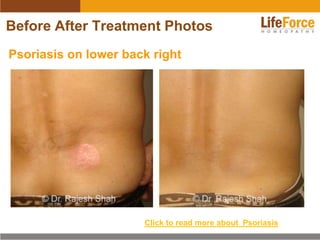 Psoriasis on Back Photos: Before After Treatment Pictures of Patients ...