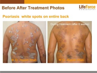 Psoriasis on Back Photos: Before After Treatment Pictures of Patients ...