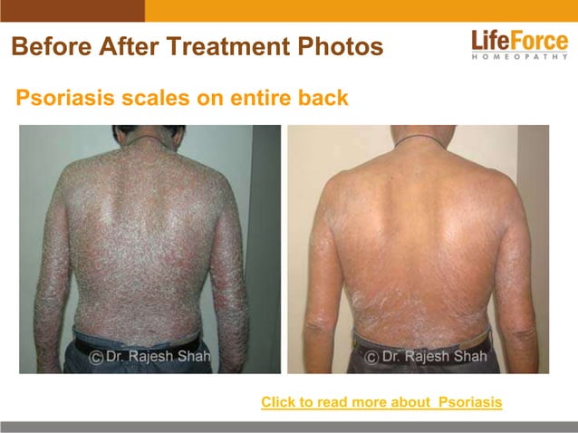 Psoriasis on Back Photos: Before After Treatment Pictures of Patients ...