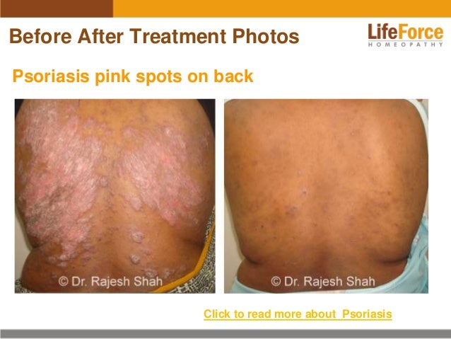 Psoriasis on Back Photos: Before After Treatment Pictures of Patients…