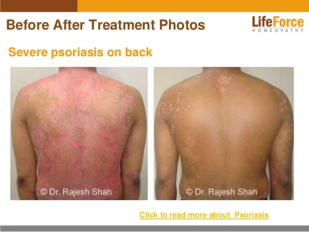 Psoriasis on Back Photos: Before After Treatment Pictures of Patients…