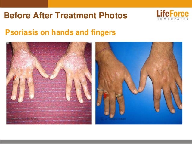Psoriasis On Fingers Treatment