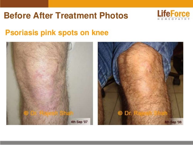 Psoriasis On Legs Photos Before After Treatment Pictures Of Patients