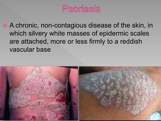 Psoriasis recent advances and existing therapy in psoriasis | PPTX