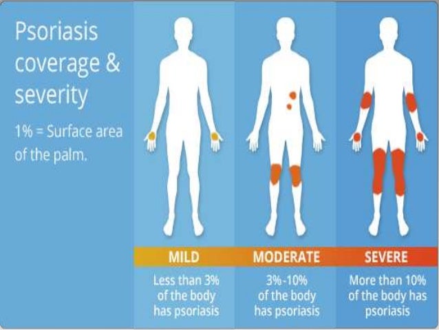 Psoriasis recent advances and existing therapy in psoriasis