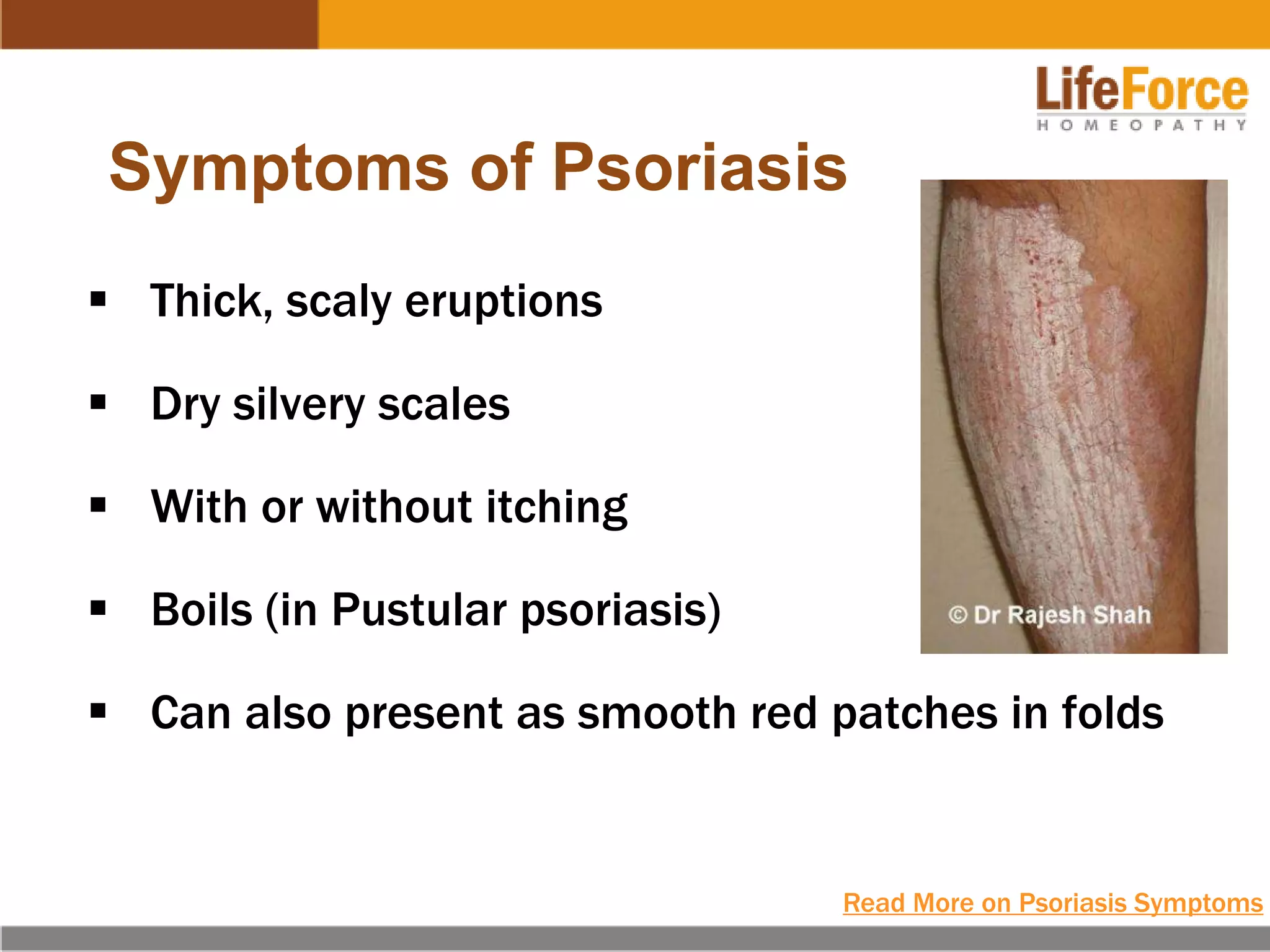 Psoriasis: Causes & Homeopathic Treatment for Psoriasis in Mumbai | PPTX