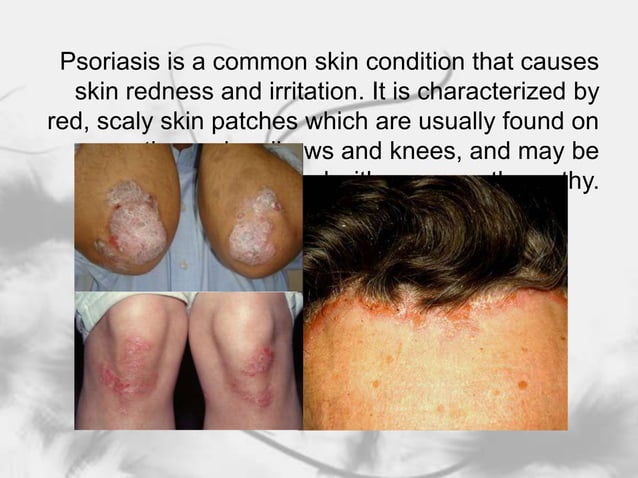 Psoriasis | PPTX | Skin and Dermatology | Diseases and Conditions