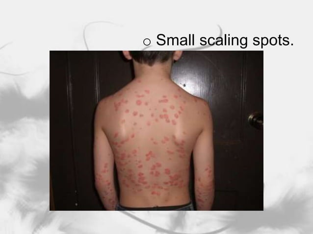 Psoriasis | PPTX | Skin and Dermatology | Diseases and Conditions