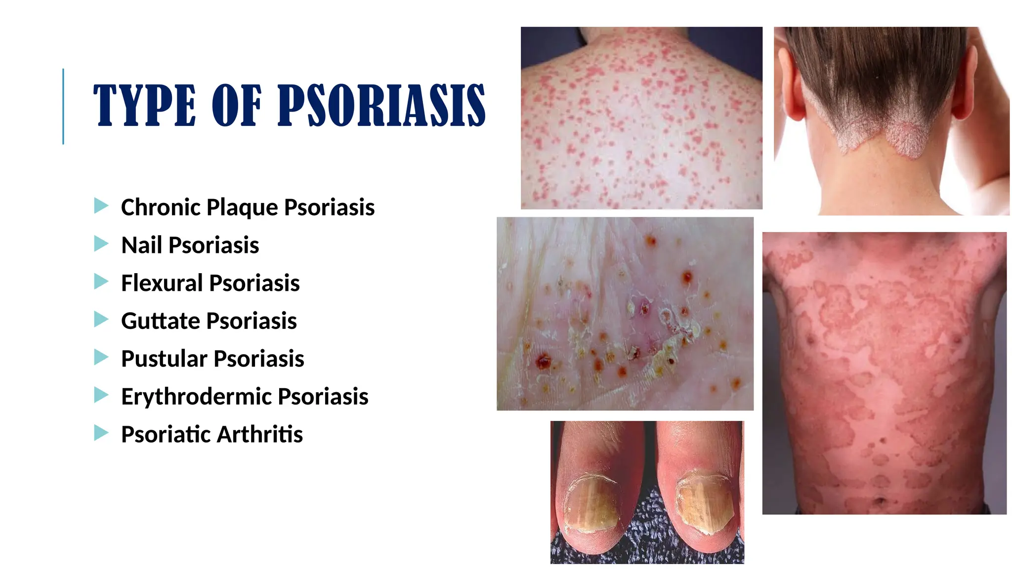 PSORIASIS dermatology slideshow by students | PPTX