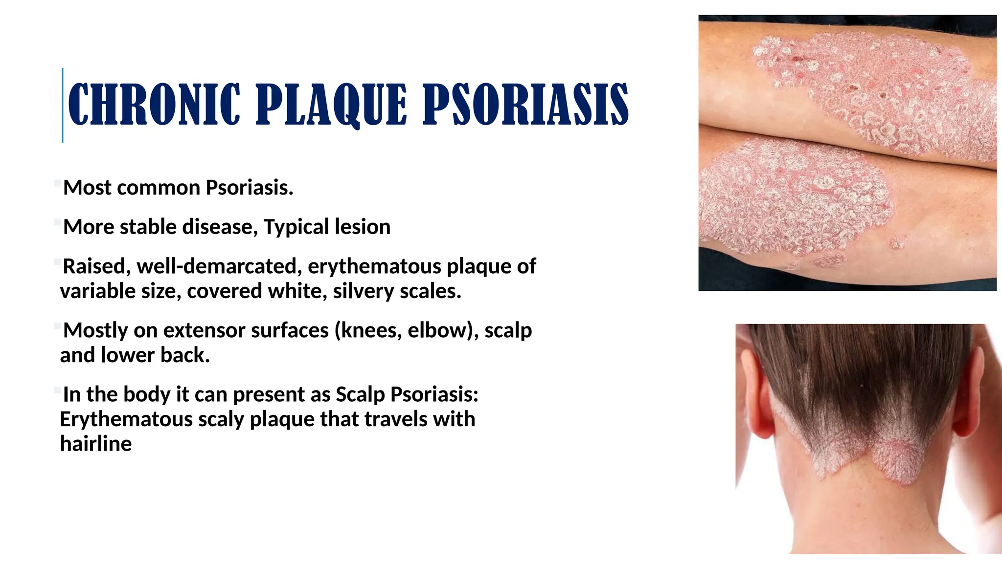 PSORIASIS dermatology slideshow by students | PPTX