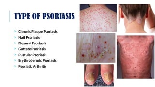 PSORIASIS dermatology slideshow by students | PPTX