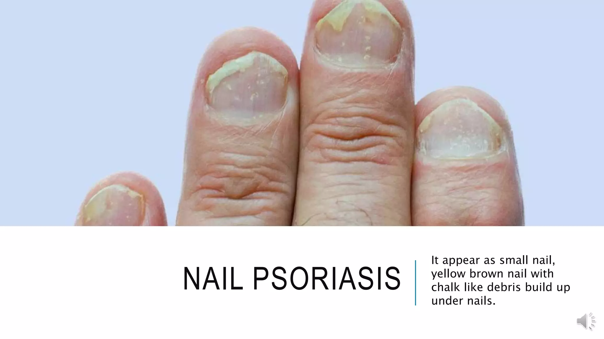 Psoriasis (1).pptx
