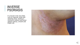 Psoriasis (1).pptx
