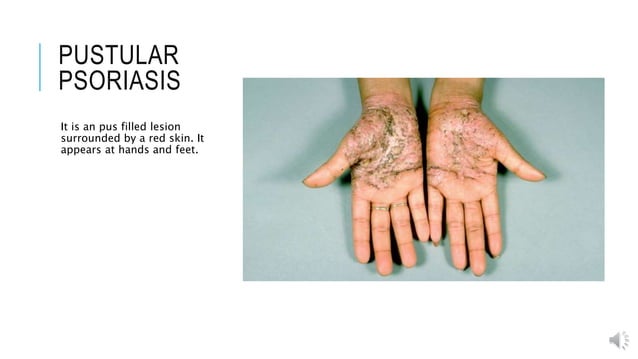 Psoriasis (1).pptx