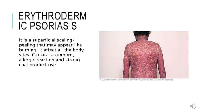 Psoriasis (1).pptx