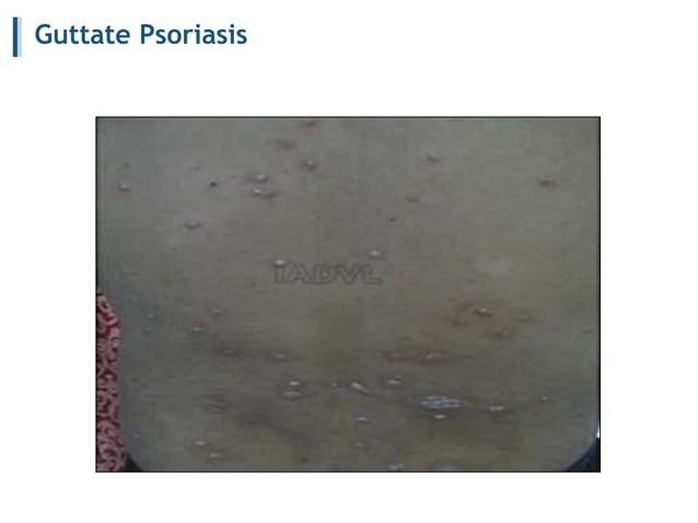 PSORIASIS (1).pptx