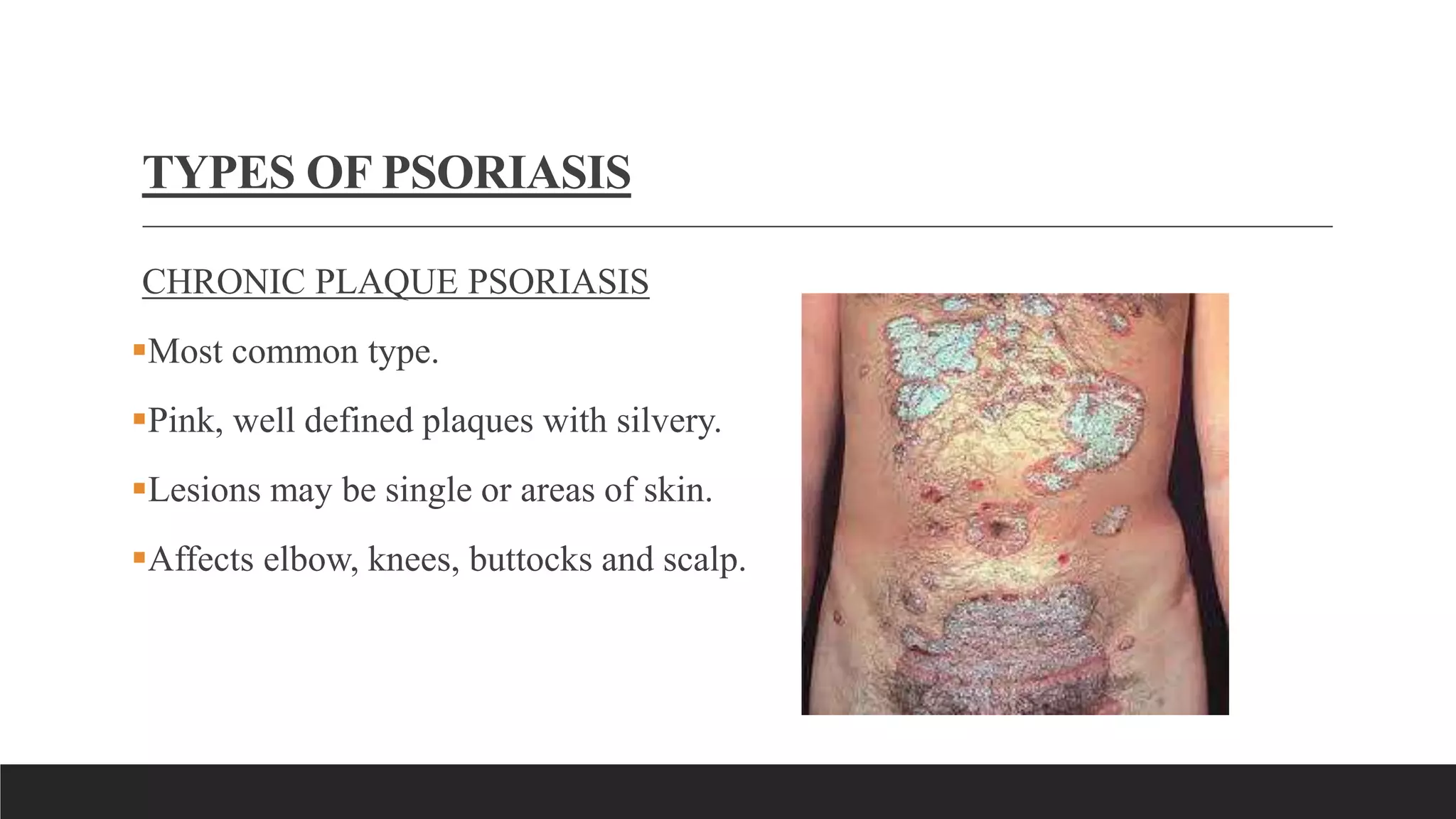 Psoriasis (1).pptx