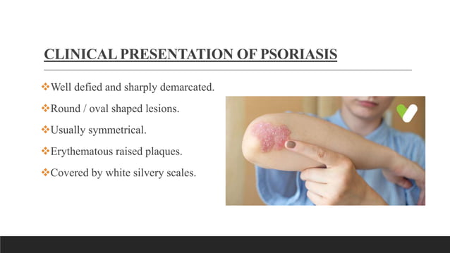 Psoriasis (1).pptx