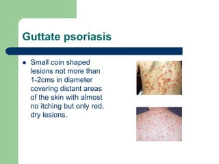 psoriasis1 (2).ppt | Skin and Dermatology | Diseases and Conditions