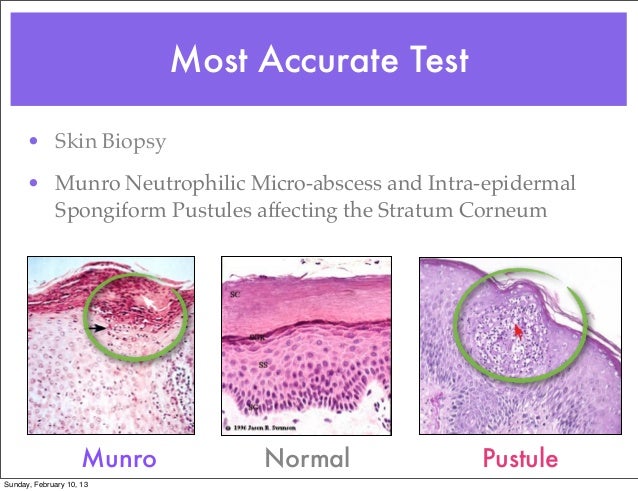 Psoriasis - Clinical