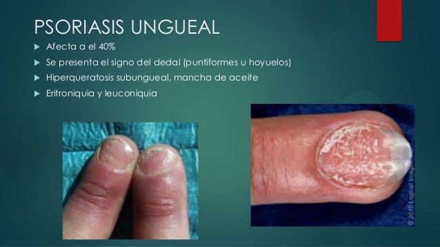 Psoriasis