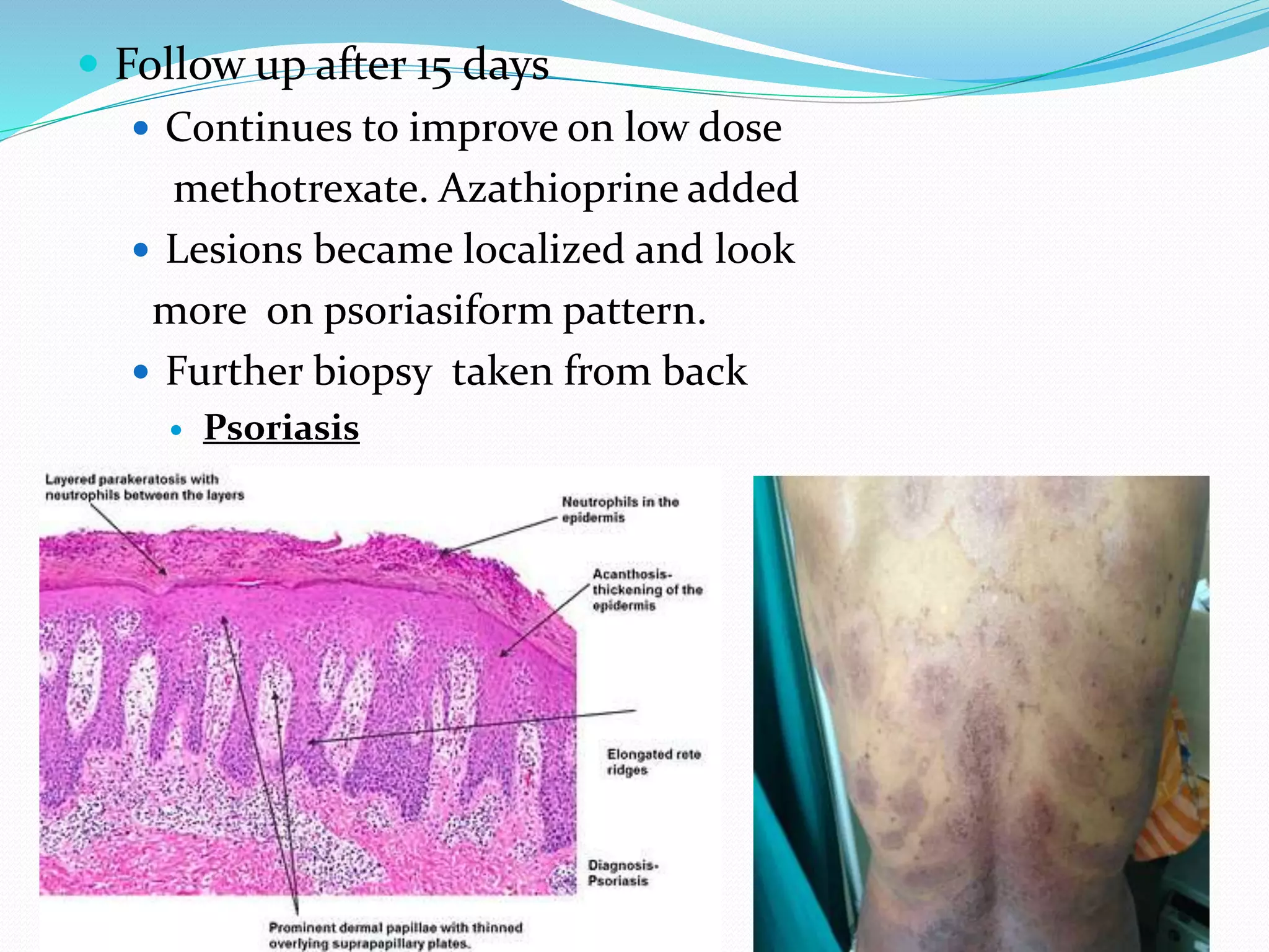 Psoriasis and subacute cutaneous lupus erythmatosis overlap deciding ...