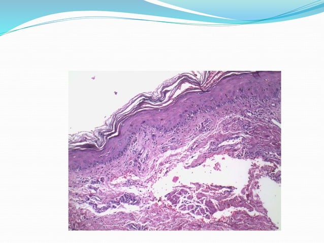 Psoriasis and subacute cutaneous lupus erythmatosis overlap deciding ...