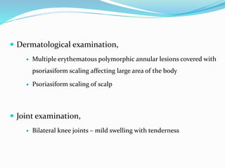 Psoriasis and subacute cutaneous lupus erythmatosis overlap deciding ...