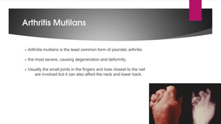 psoriasis arthritis.pdf one can refer this | PDF