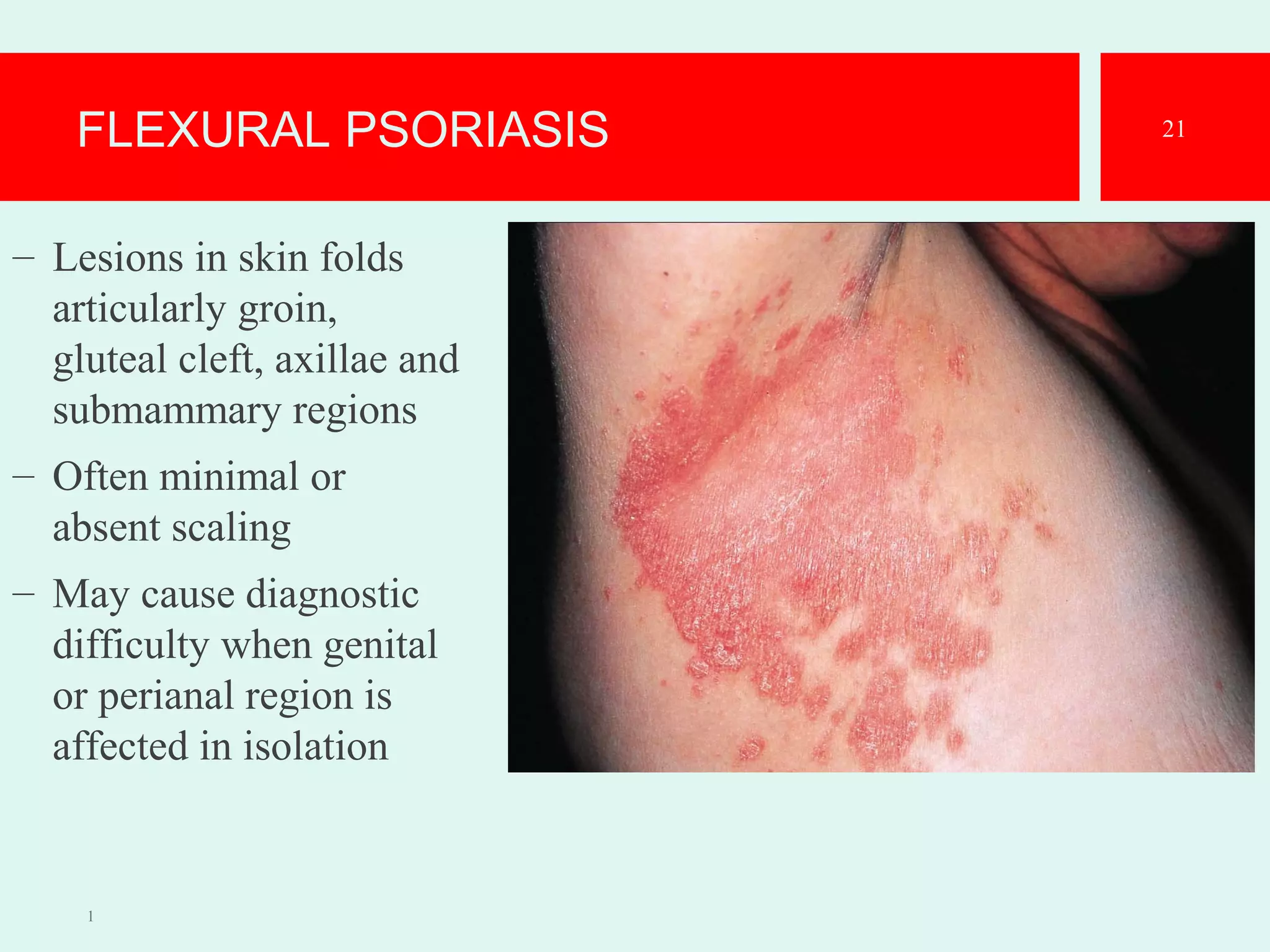 Psoriasis-The best Presentation | PPT