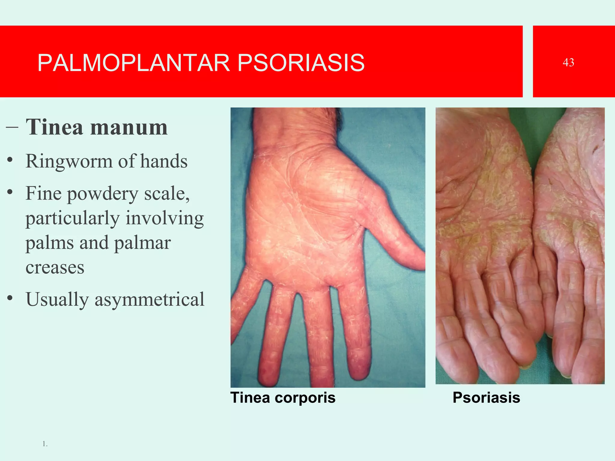 Psoriasis-The best Presentation | PPT