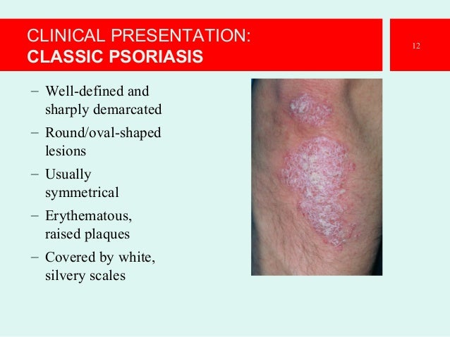 Psoriasis-The best Presentation