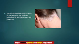 conoce la Psoriasis cuero cabelludo y como tratarla | PPTX