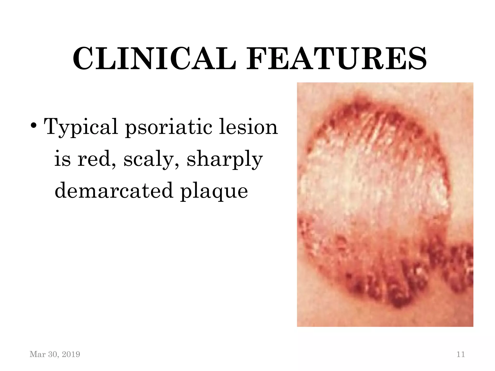 Psoriasis (dermatology) | PPT