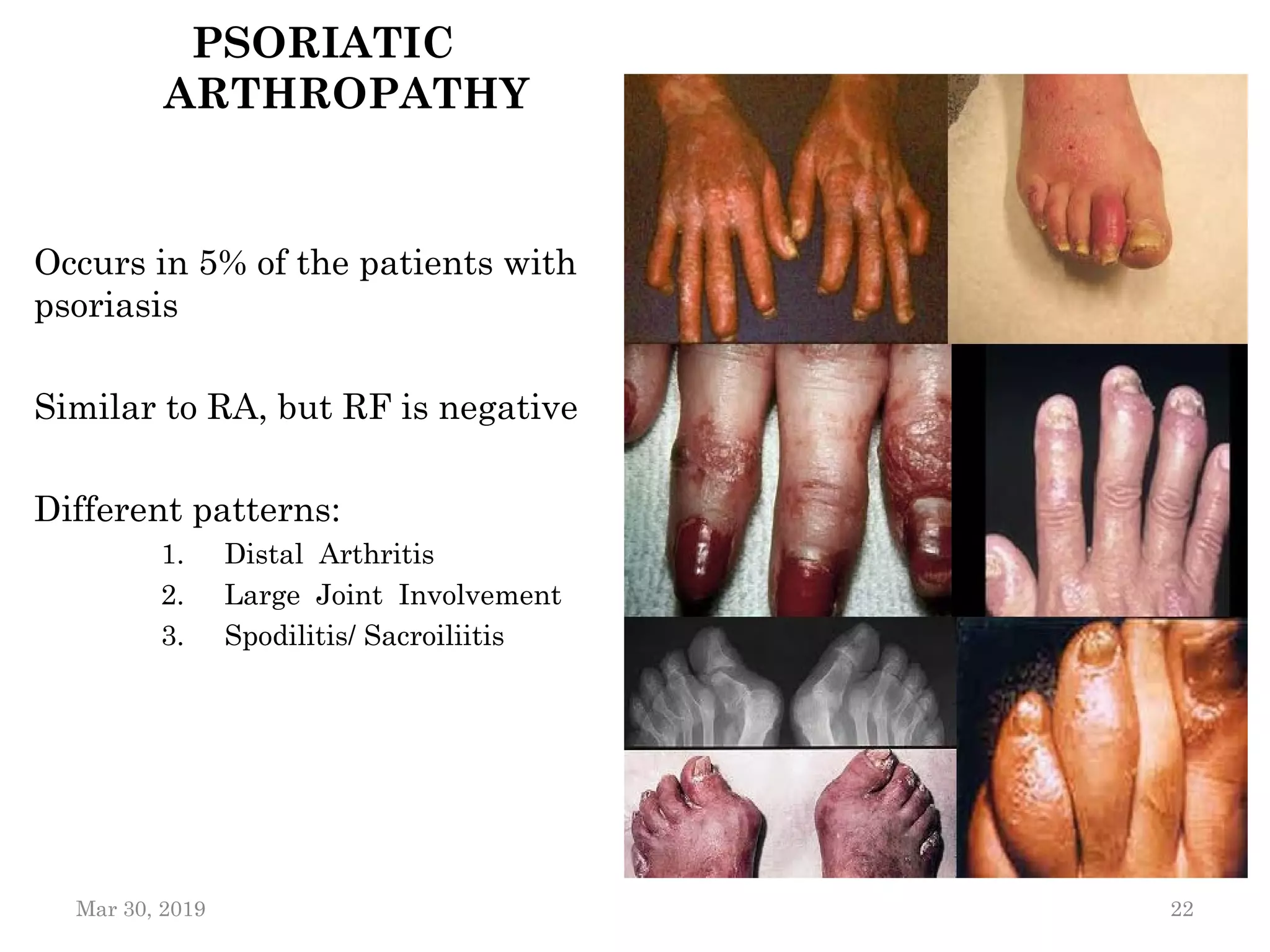 Psoriasis (dermatology) | PPT