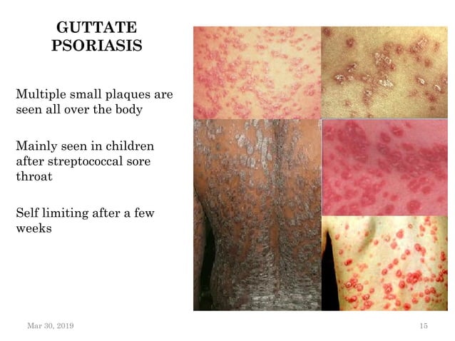 Psoriasis (dermatology) | PPT